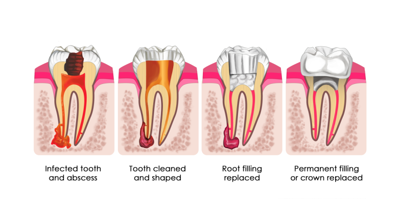 ROOT CANAL TREATMENT – DentalWiz